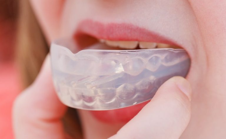 Protectores bucales para niños | Clínica Dental en Valladolid Galván Lobo
